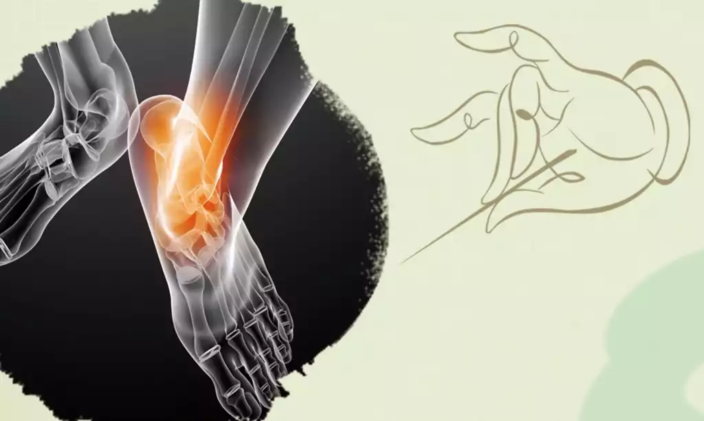Acupunctuur bij JICHT – CMDC